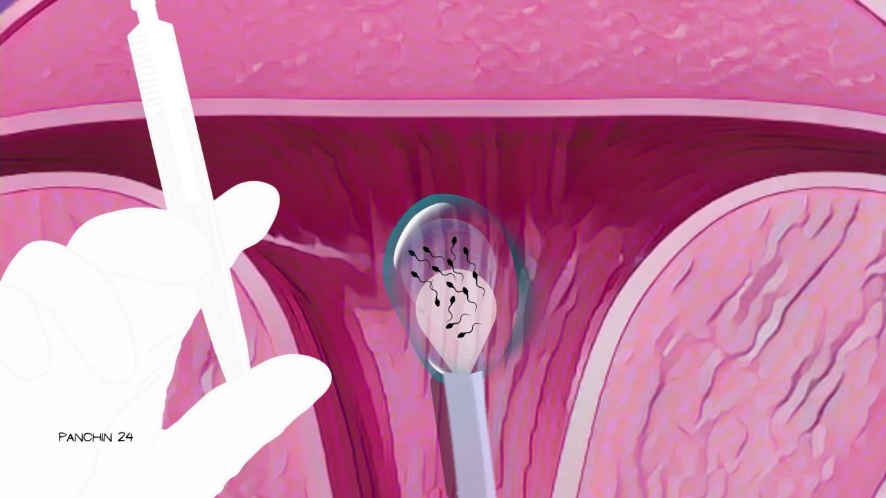 Inseminación artificial: Cómo se realiza y tasas de embarazo